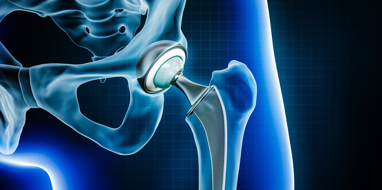 What Happens in a Hip Operation? - 5 things to do today